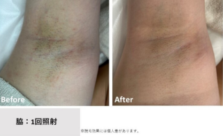 夏に向けての脱毛開始♪|エステティックサロンKoko|フレスポ 夏に向けての脱毛開始♪|エステティックサロンKoko|フレスポ